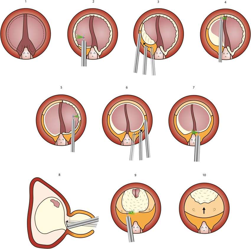 O que é HoLEP: Tratamento a Laser para HPB